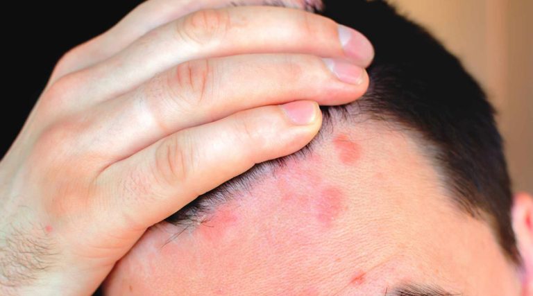 Hives On The Forehead: Everything You Need To Know